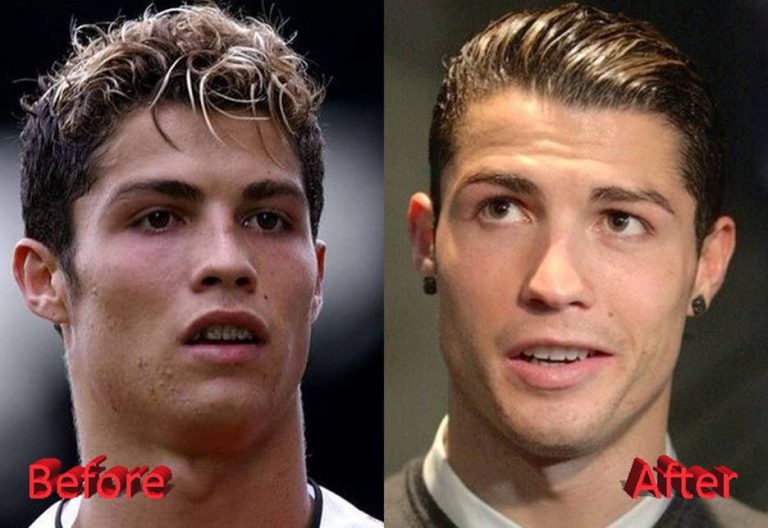 Cristiano Ronaldo’s Before and After Plastic Surgery Photos are ...